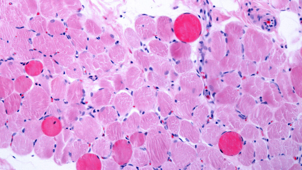 Capricor Reports Significant Progress in Duchenne Therapy - THENCVOICE